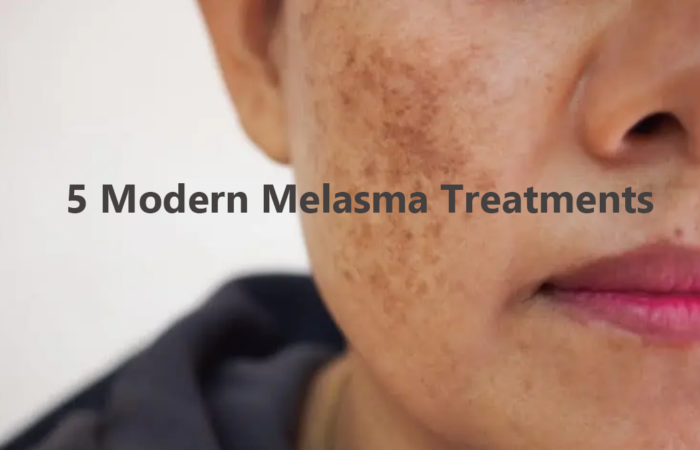 5 Modern Melasma Treatments - CebuImage