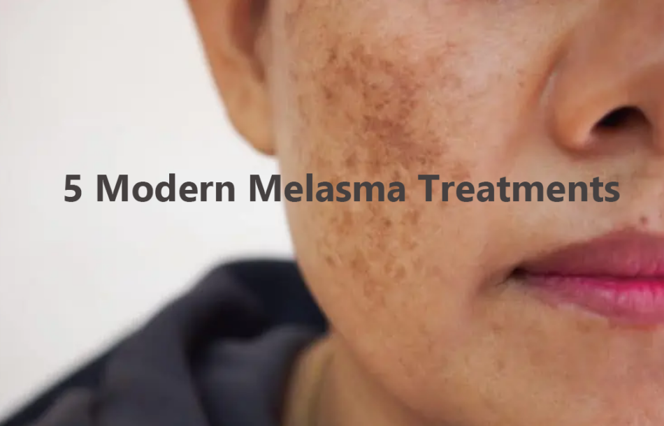 5 Modern Melasma Treatments - CebuImage